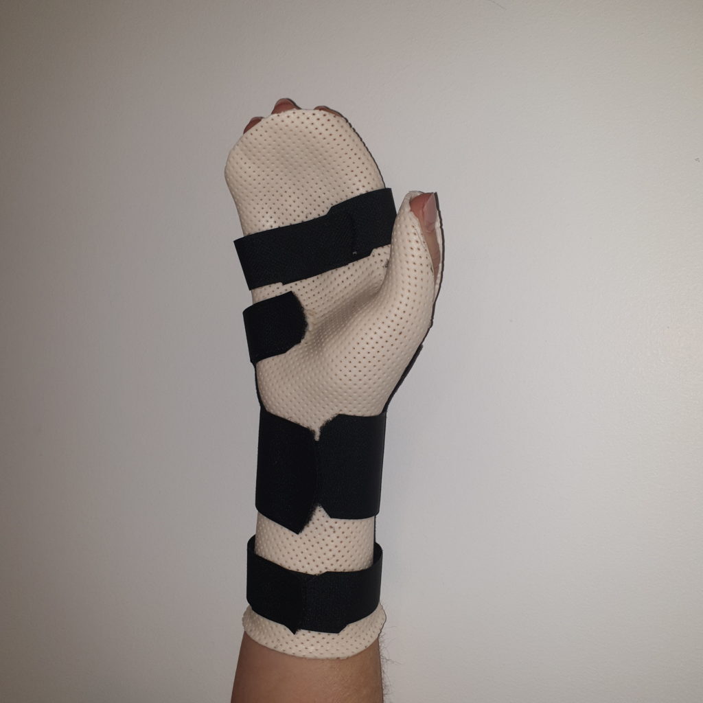 L’orthèse, ou attelle de capener. - Orthèses et atelles main ...