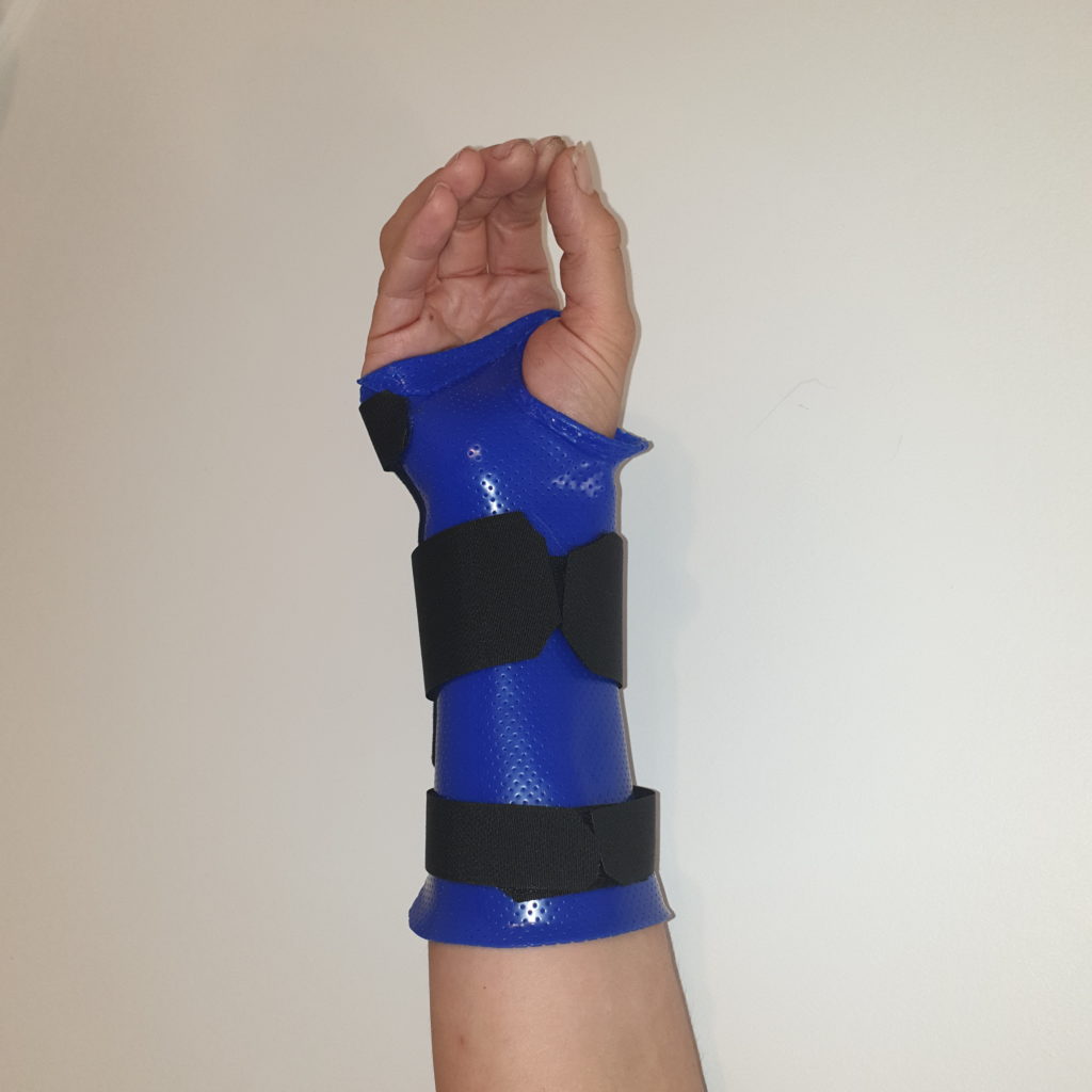 L’orthèse, ou attelle de capener. - Orthèses et atelles main ...