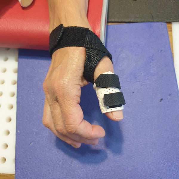 L’orthèse, ou attelle de capener. - Orthèses et atelles main ...